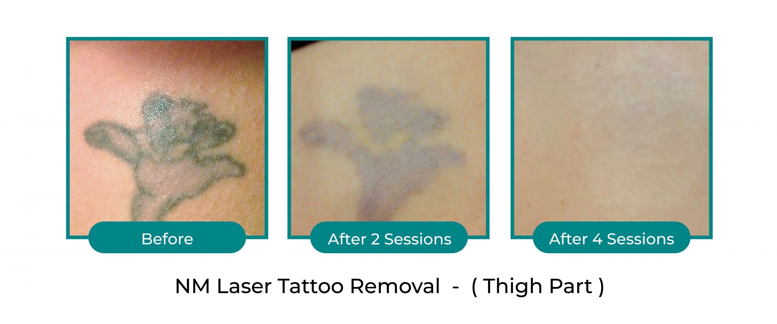 Best Laser Tattoo Removal in Malaysia - NextMed Clinic