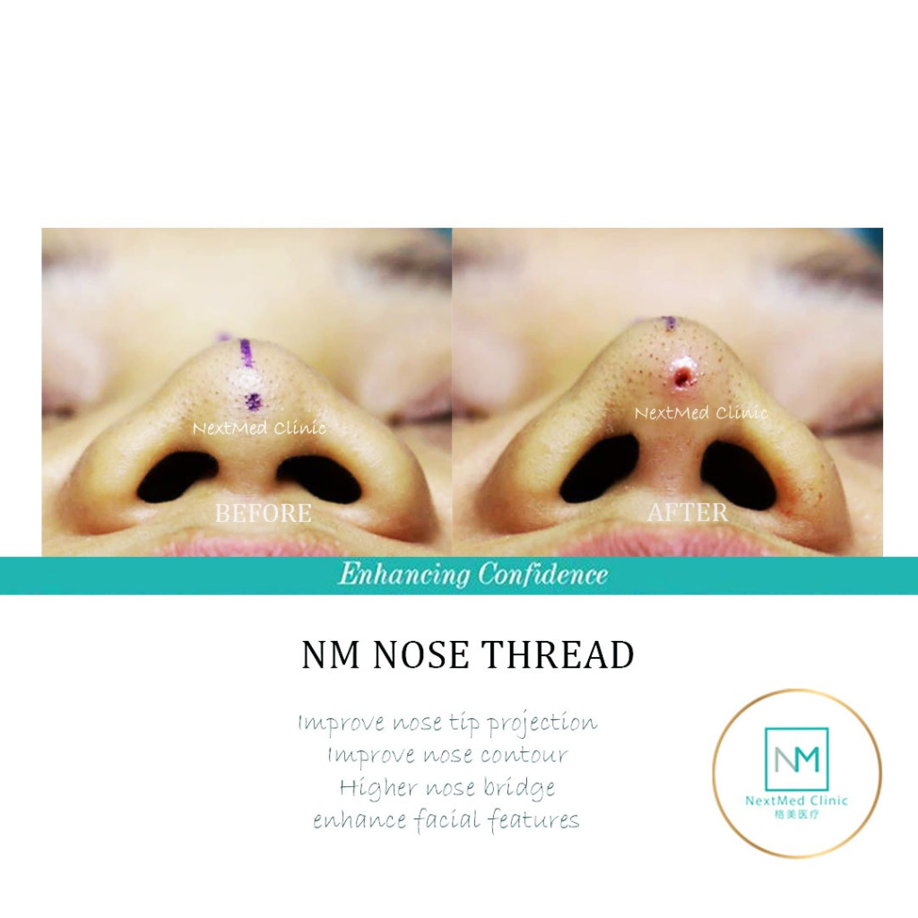 Best Nose Thread Lift in Cheras, Kajang and Sungai Long - NextMed Clinic