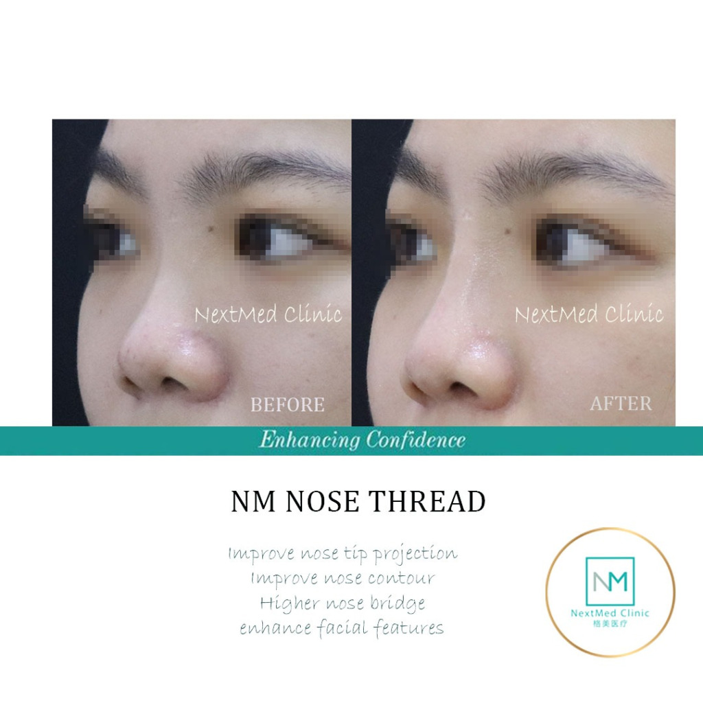Best Nose Thread Lift in Cheras, Kajang and Sungai Long - NextMed Clinic