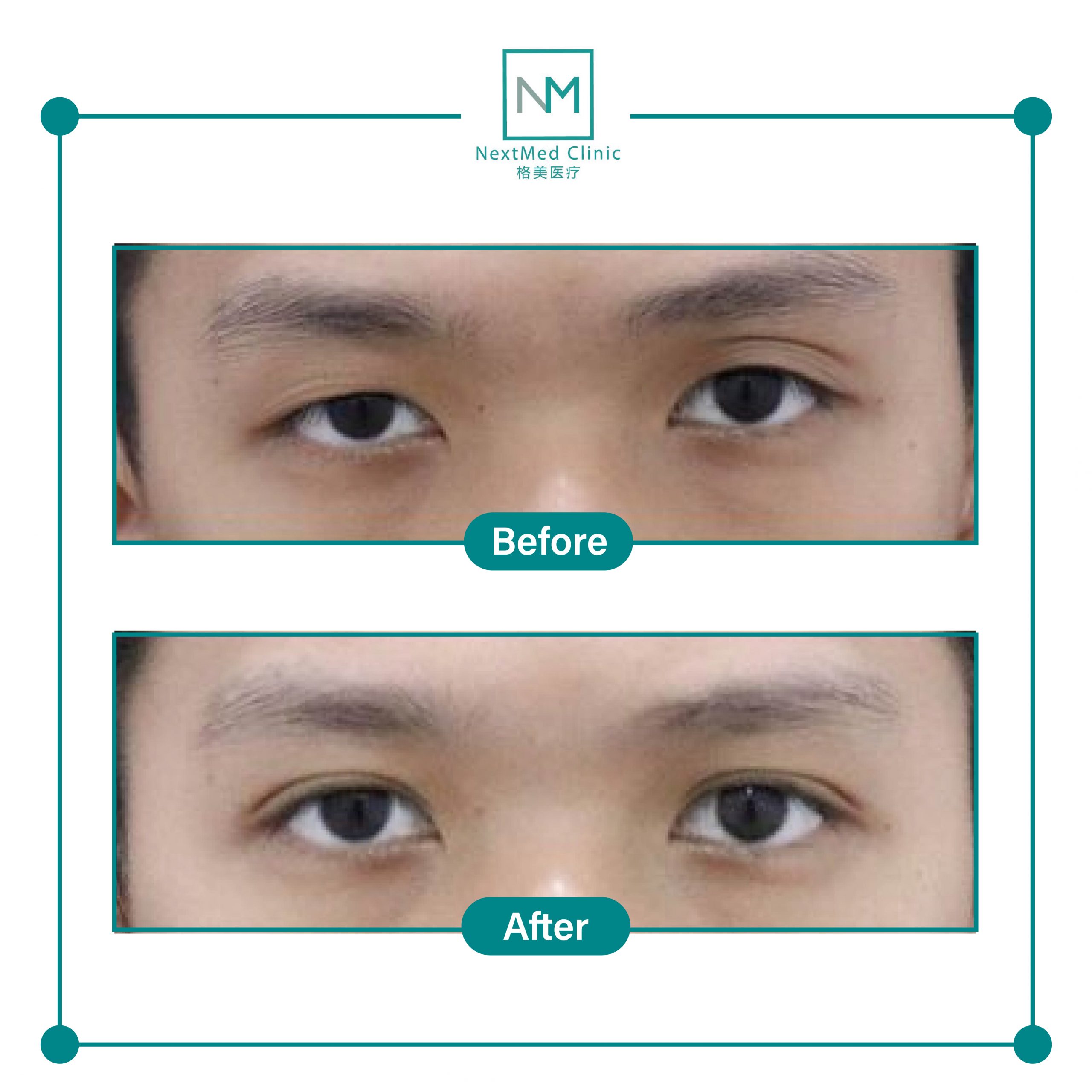 Understanding Double Eyelid Sutures: A Deep Dive into Top FAQs ...