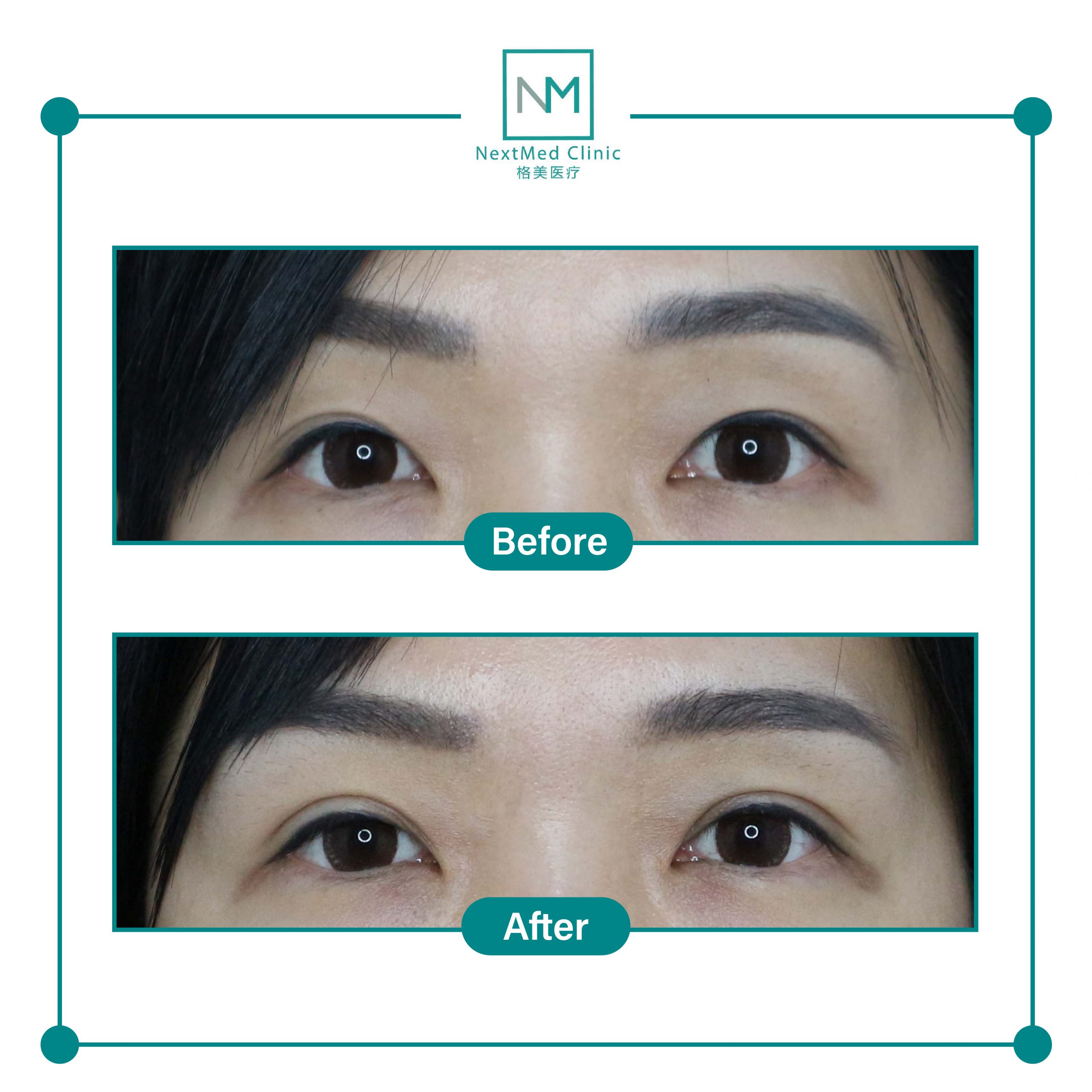 Unlocking Radiant Beauty: The Marvels of Double Eyelid Suture Benefits ...
