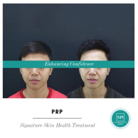 PRP Malaysia - Best Clinic For PRP Treatment in Malaysia - NextMed Clinic