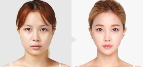 V-shape face clinic in Kl and Selangor - NextMed Clinic