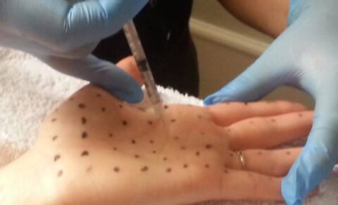 Best Excessive Sweating Treatment in Malaysia - NextMed Clinic