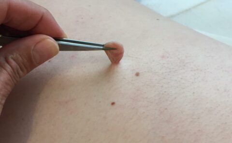 Best Skin Tag Removal Clinic in Kuala Lumpur & Selangor - NextMed Clinic