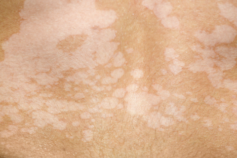 FAQs for Fungal Infection Symptoms - NextMed Clinic