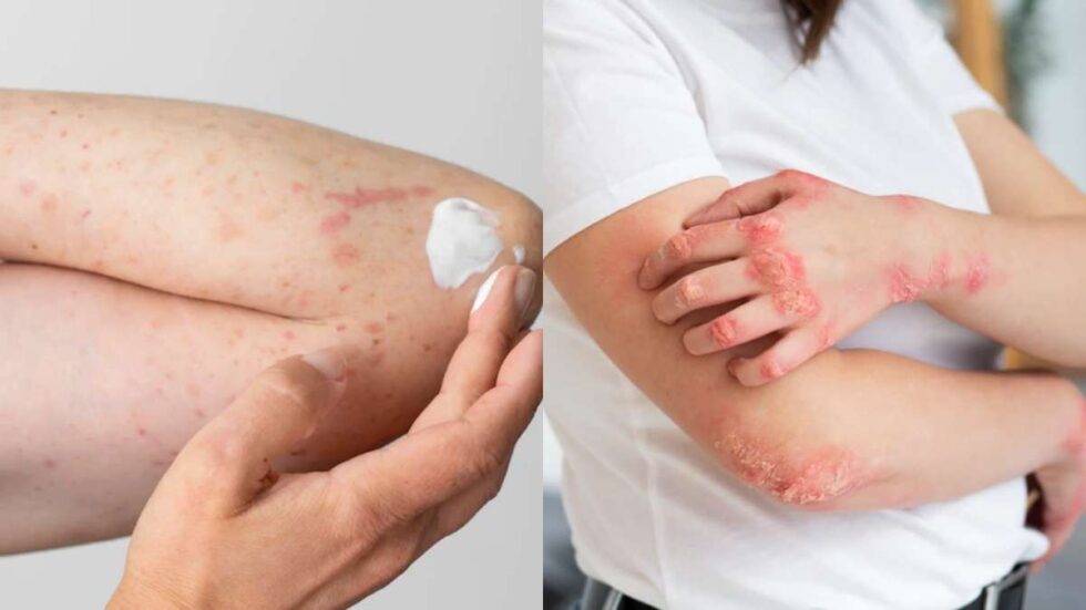 FAQs for Fungal Infection Symptoms - NextMed Clinic