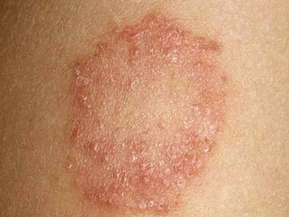 Decoding Skin Rashes: Unveiling the Culprits Behind the Itch - NextMed ...