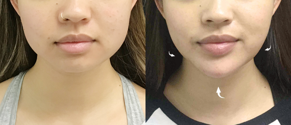 Unveiling the Beauty Secret: V-Shape Face Treatment - NextMed Clinic