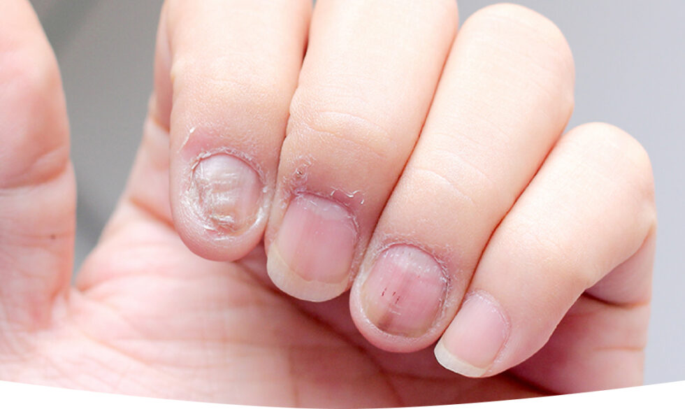 Nail Fungal Infection Treatment - NextMed Clinic