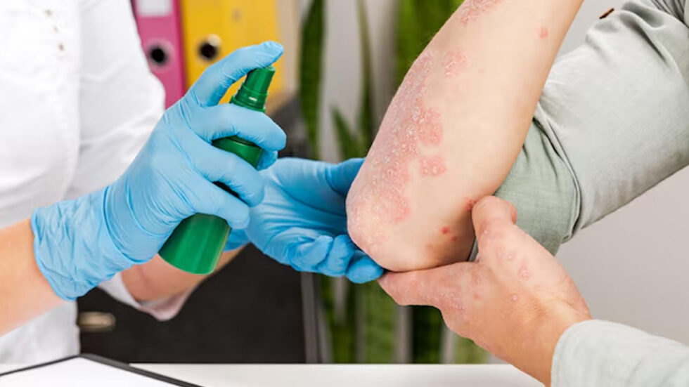 Understanding Fungal Infections: Why Sweating Makes You More Vulnerable ...