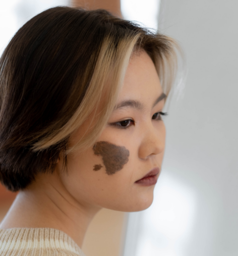 Types of Birthmarks: Understanding Your Skin Concerns - NextMed Clinic