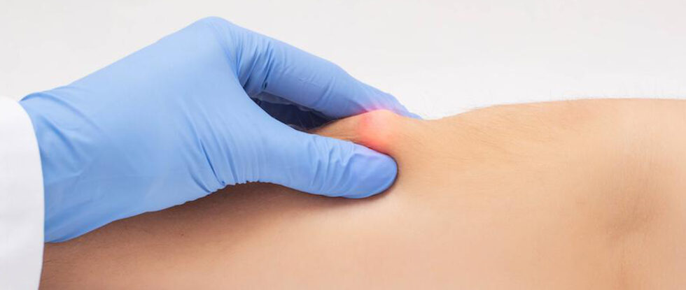 Fat Tumor (Lipoma): Causes, Symptoms, and Treatment Options - NextMed ...