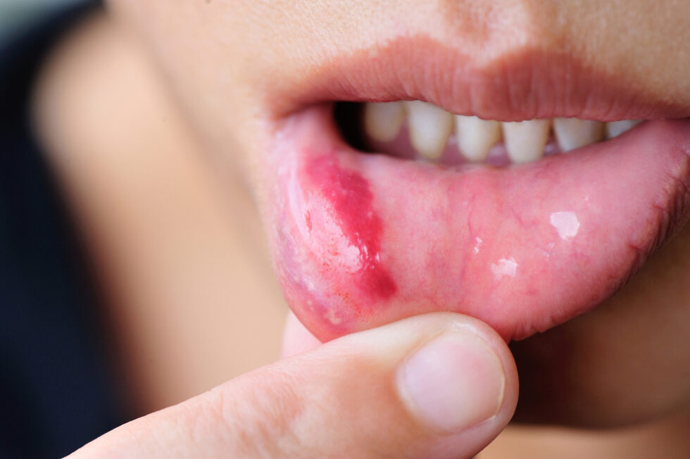 Oral Thrush in Immunocompromised Individuals - NextMed Clinic