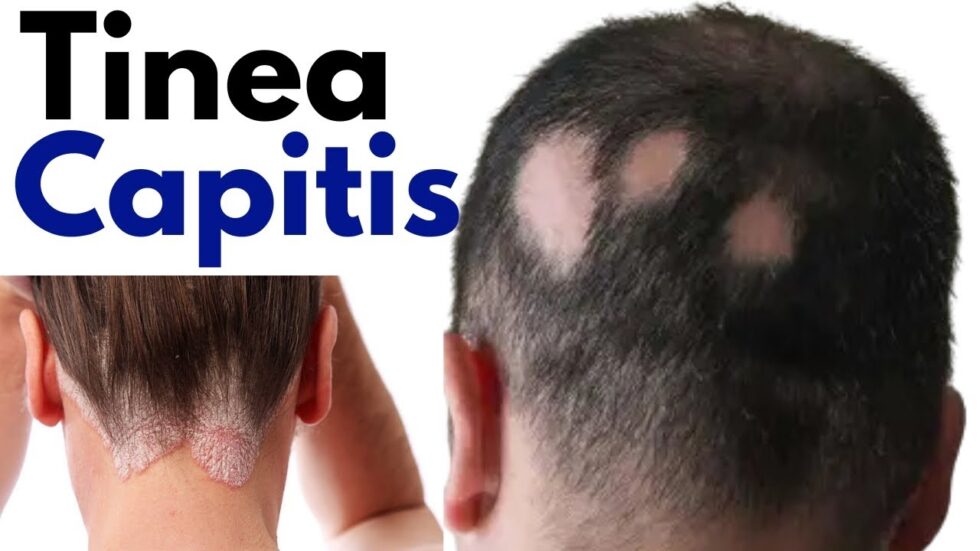 Tinea Capitis (Scalp Ringworm) and Hair Loss - NextMed Clinic