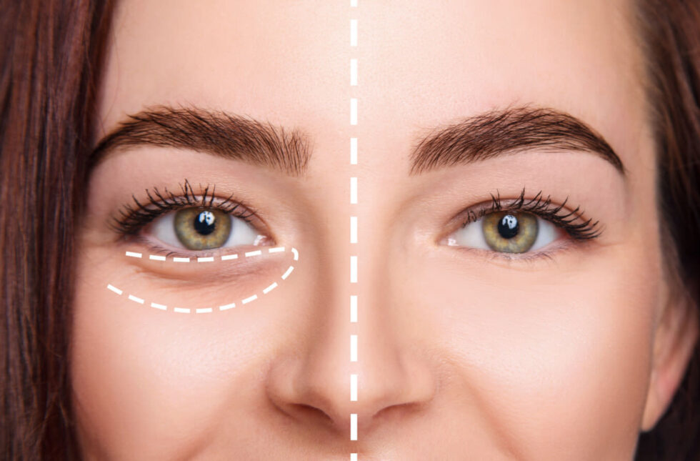 FAQ on Dermal Fillers: Jawline, Tear Trough, and Chin - NextMed Clinic