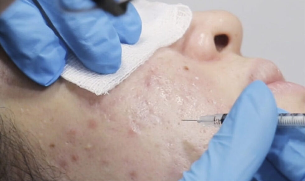 TCA Cross vs. Subcision: The Best Acne Scar Treatments for Deep Scars ...