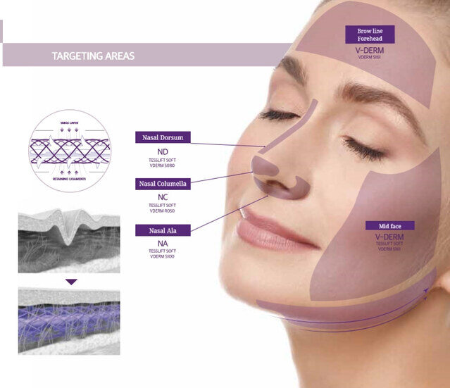 Tesslift vs Normal Thread Lift – Which Is Better in Malaysia? - NextMed ...